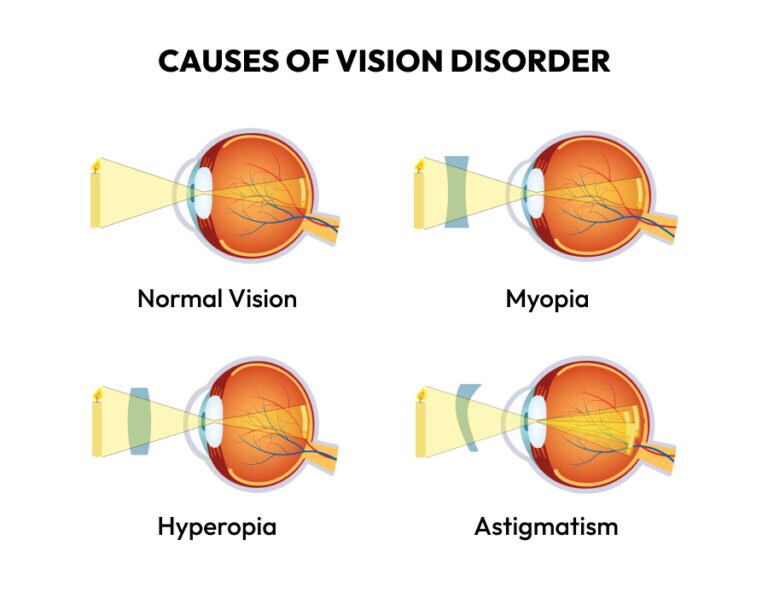 Understanding 20/100 Vision: What It Means and How to Manage It | Blog ...
